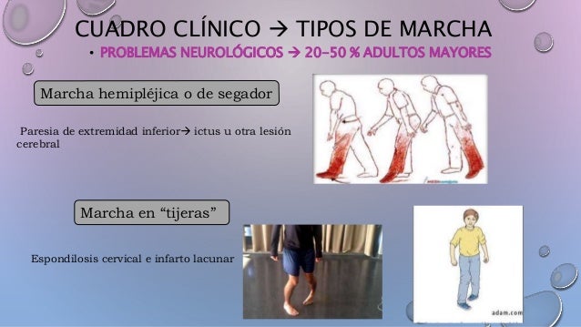 Trastornos de-la-marcha-y-caidas