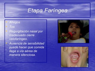 Trastornos de la_deglucion_en_ninos_ii | PDF