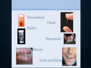 expectoracion | PPTX