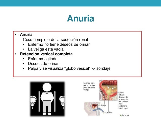 Anuria