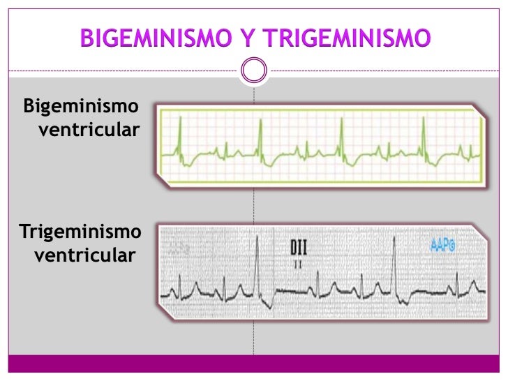 Trigeminismo Ventricular Arritmias 1 Dx MC | Quizlet