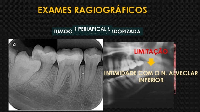 DENTES INCLUSOS E IMPACTADOS