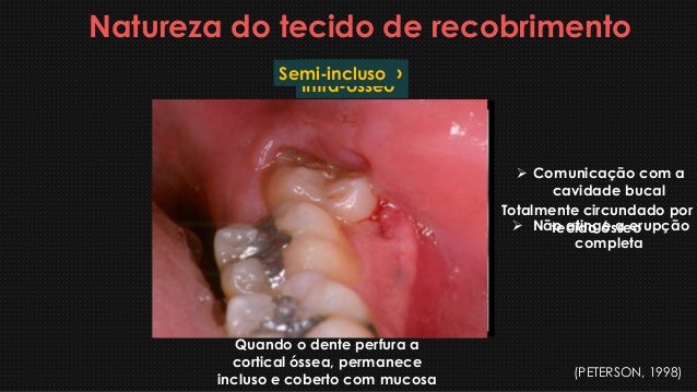 DENTES INCLUSOS E IMPACTADOS