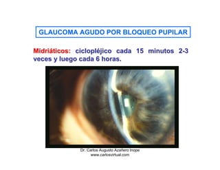 Tratamiendo Del Glaucoma Agudo | PDF | Eye and Vision Conditions ...