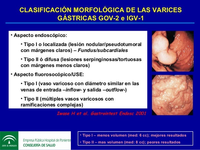 Tratamiento con cianoacrilato de las varices gástricas (2009)