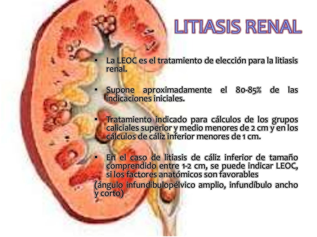 Tratamiento conservador de la litiasis urinaria gabriela sánchez