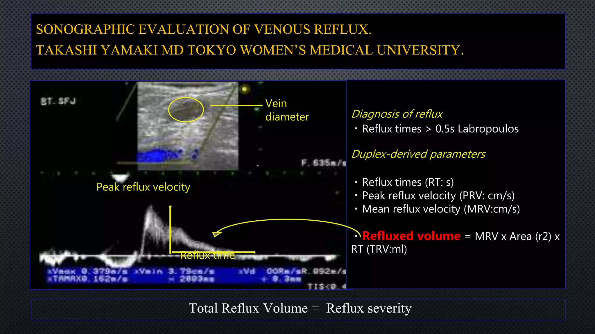Tratamiento de la insuficiencia venosa superficial | PPTX