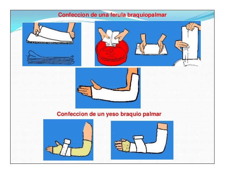 Tratamiento De Las Fracturas