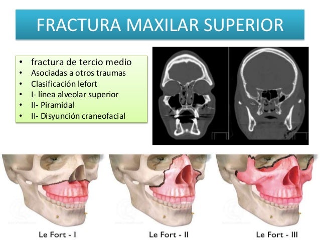 Fracturas de la mandíbula y el tercio medio de la cara, fractura ...