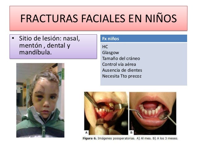 Fractura Facial: Radiología, Tipos, Tratamiento Y Tiempo De Curación ...