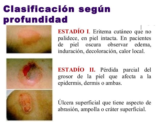 Tratamiento de las úlceras