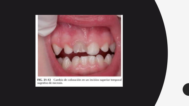 Tratamiento del diente con apice inmaduro | PPTX