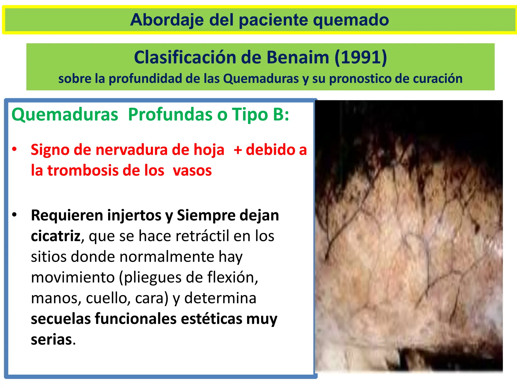 tratamiento de quemaduras protocolo .pptx