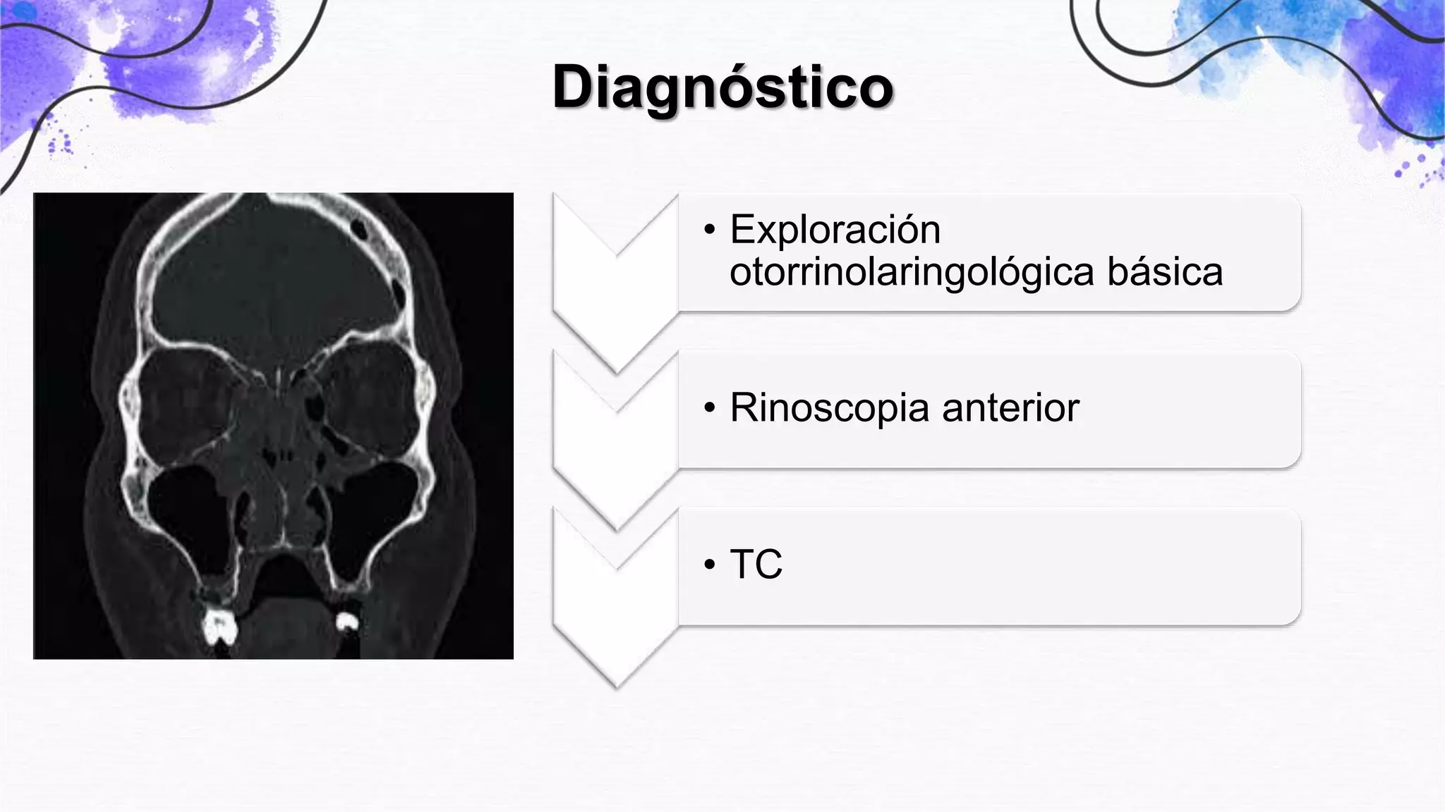 Tratamiento de Sinusitis Aguda - Crónica -Poliposis Nasosinusal.pptx