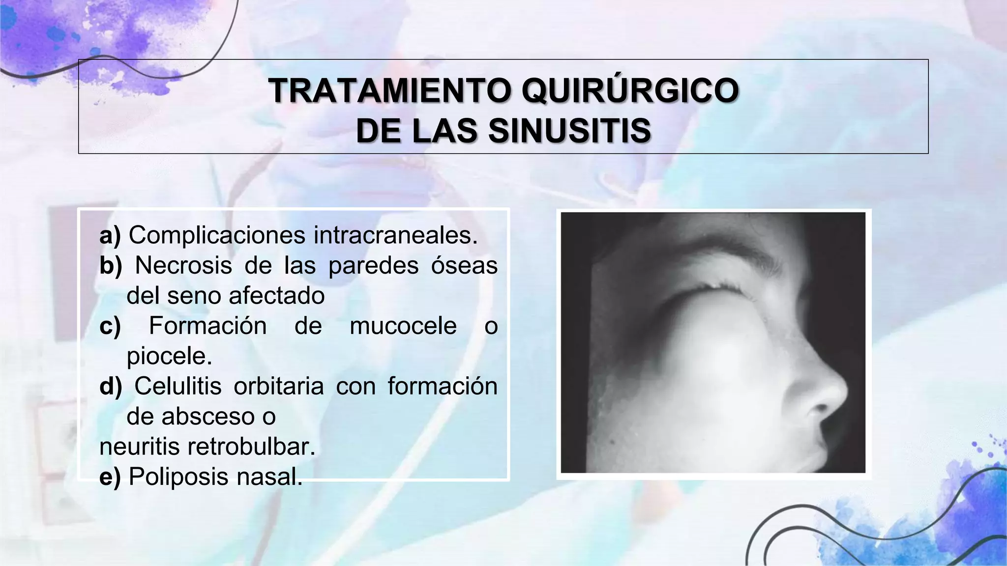 Tratamiento de Sinusitis Aguda - Crónica -Poliposis Nasosinusal.pptx