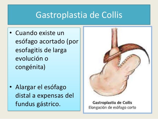 Tratamiento, enfermedad por reflujo gastroesofagico, ERGE