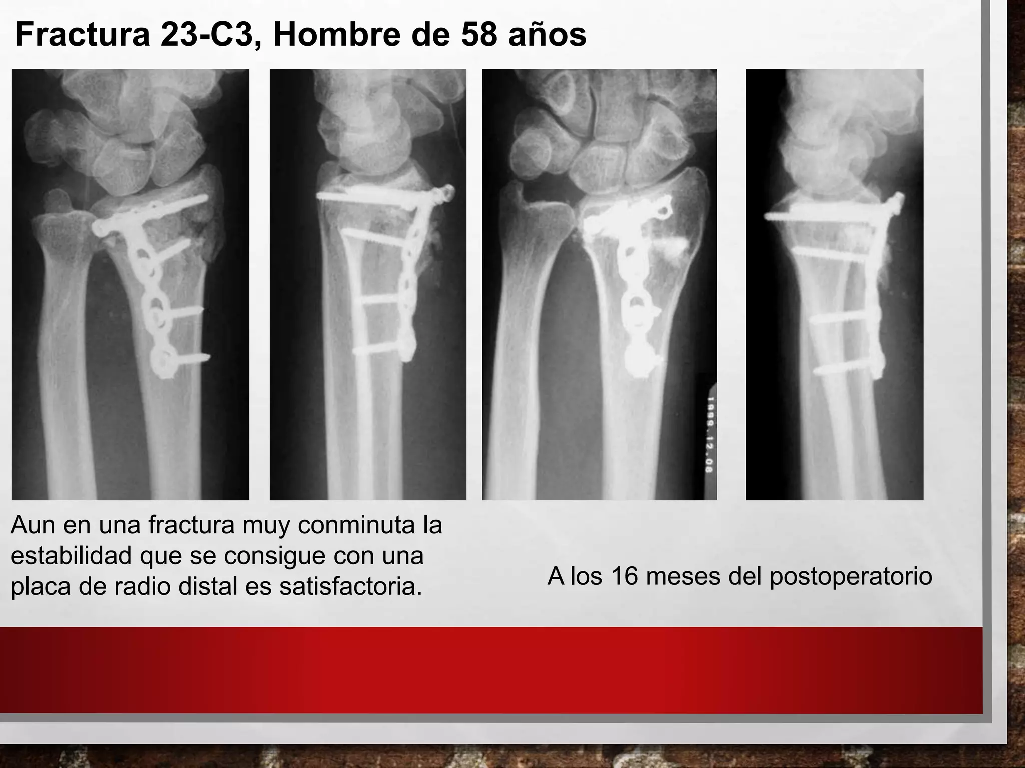 Tratamiento fractura radio proximal diafisis distal IG | PPT