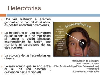 Tratamiento ortóptico de las heteroforias | PPT