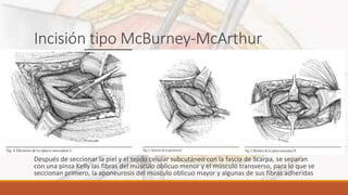Tratamiento quirúrgico de apendicitis aguda | PPTX