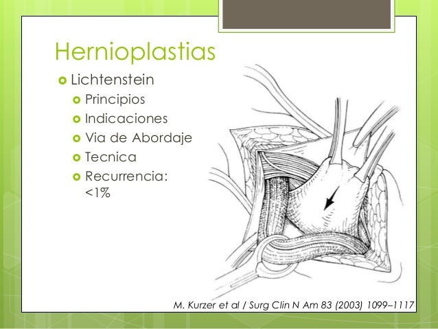 Tratamiento Quirurgico De Las Hernias Inguinales