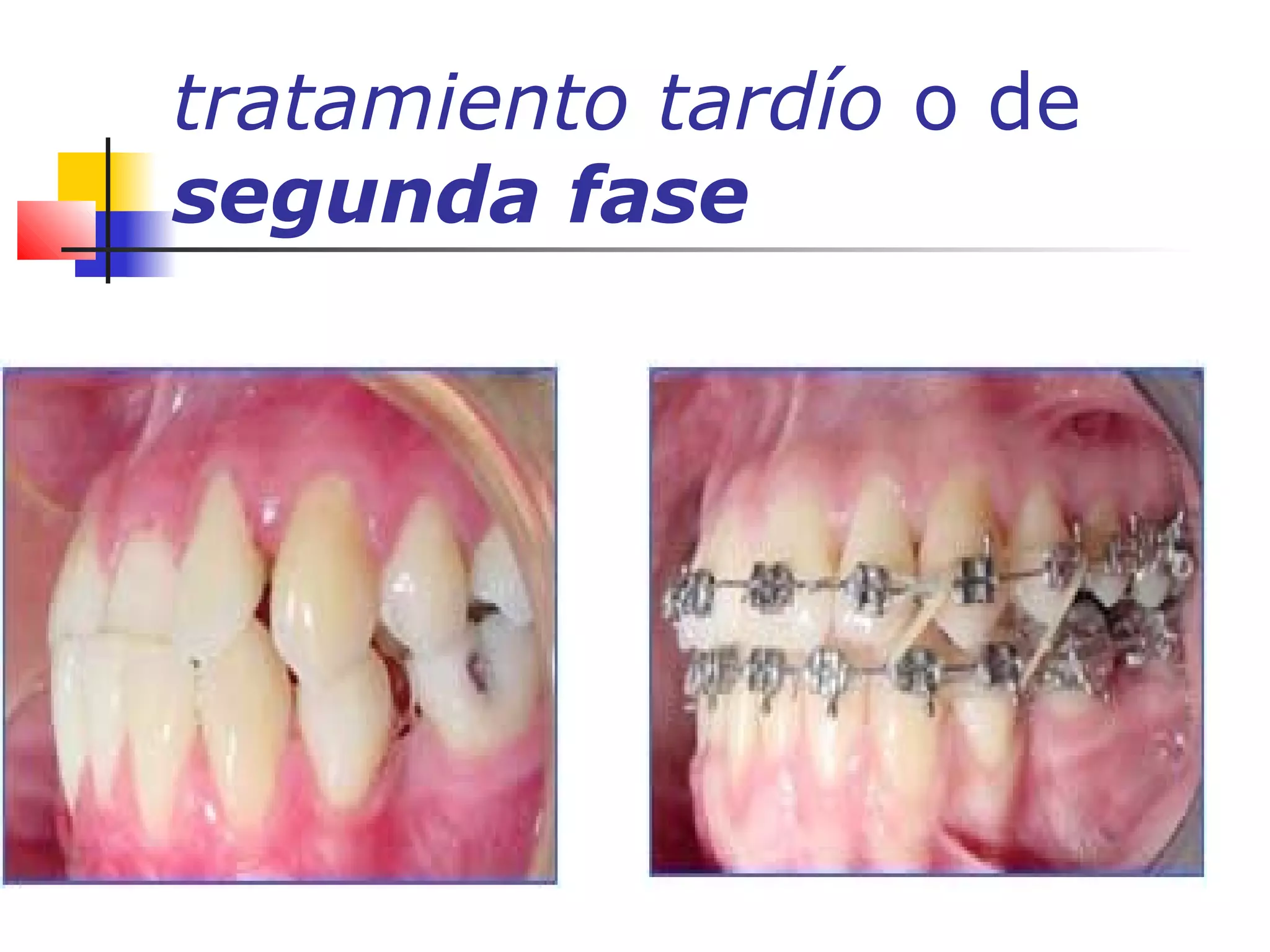 Tratamiento temprano vs tardio en la clase iii | PPT