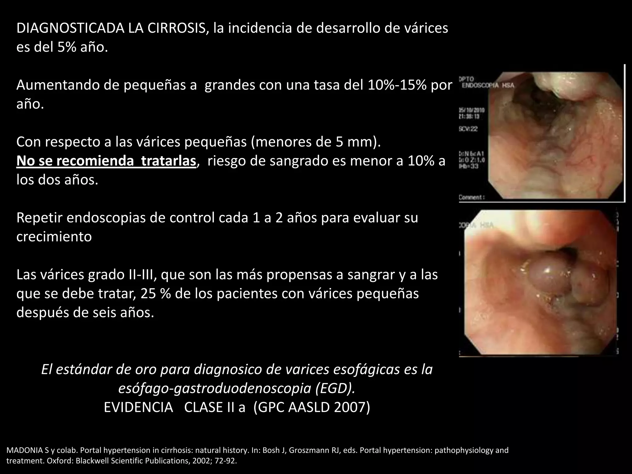 Tratamiento varices esofagicas | PPTX