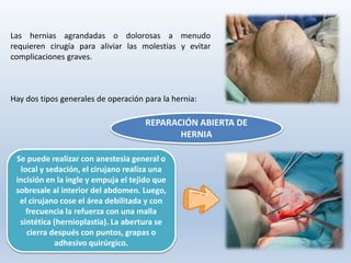 TRATAMIENTO Y PREVENCION DE LA HERNIA (1).pptx