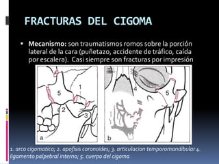 Trauma maxilofacial | PPTX