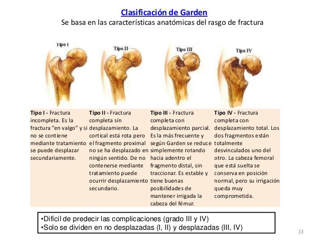 FRACTURAS DEL EXTREMO PROXIMAL DEL FEMUR