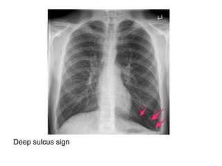 Diagnostic Imaging of Chest Trauma | PPT