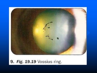 Vossius Ring