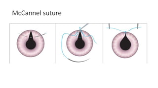 Trauma to eye | PPTX