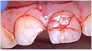 trauma to permanent teeth slide show.pptx