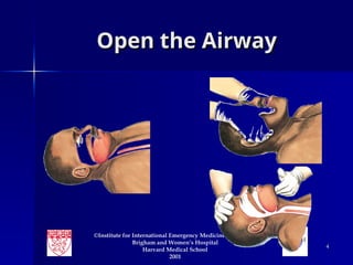 Trauma - Airway . Anesthetic management & consideration | PPT