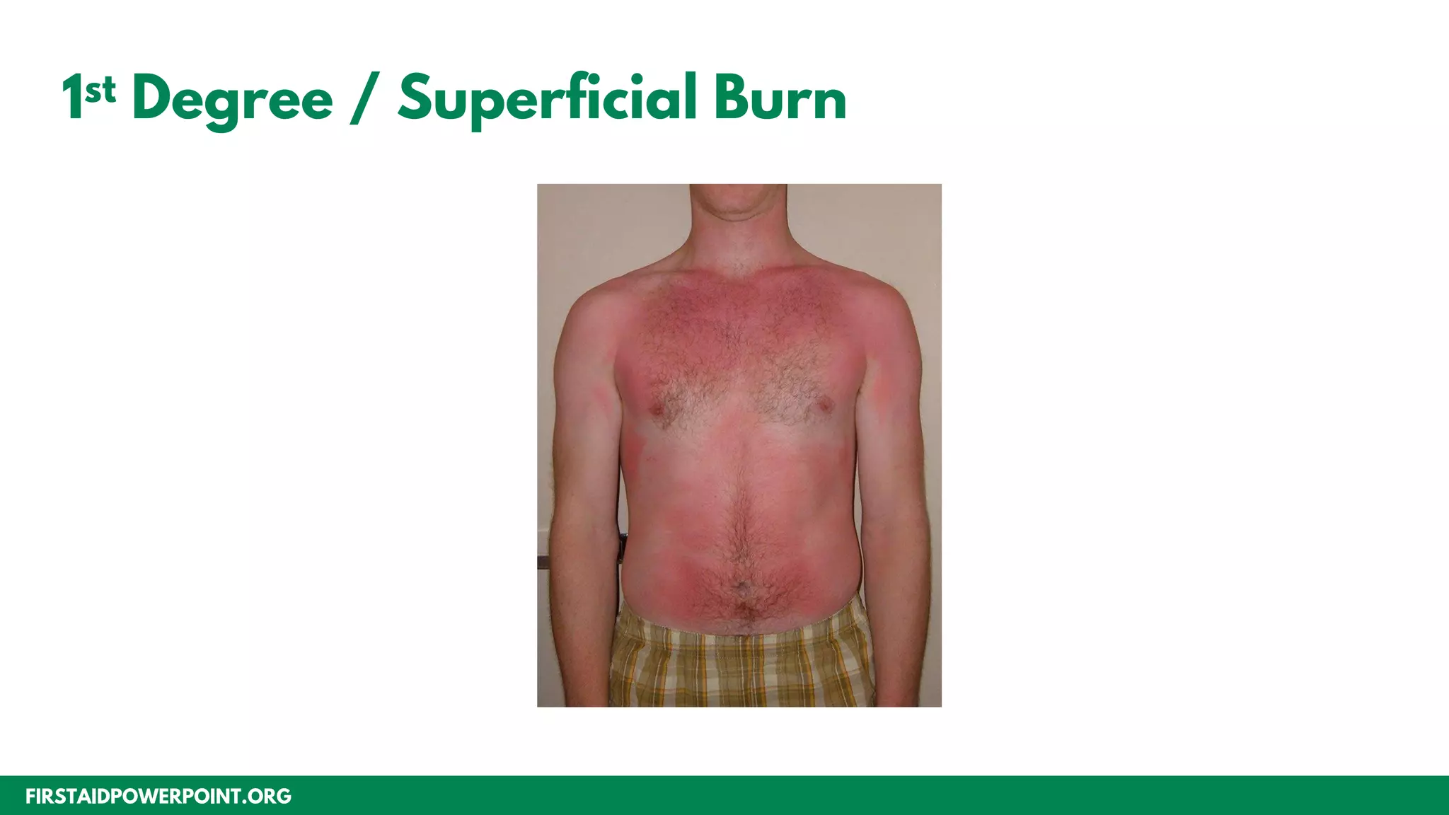 Trauma - Burn Injuries | PPTX