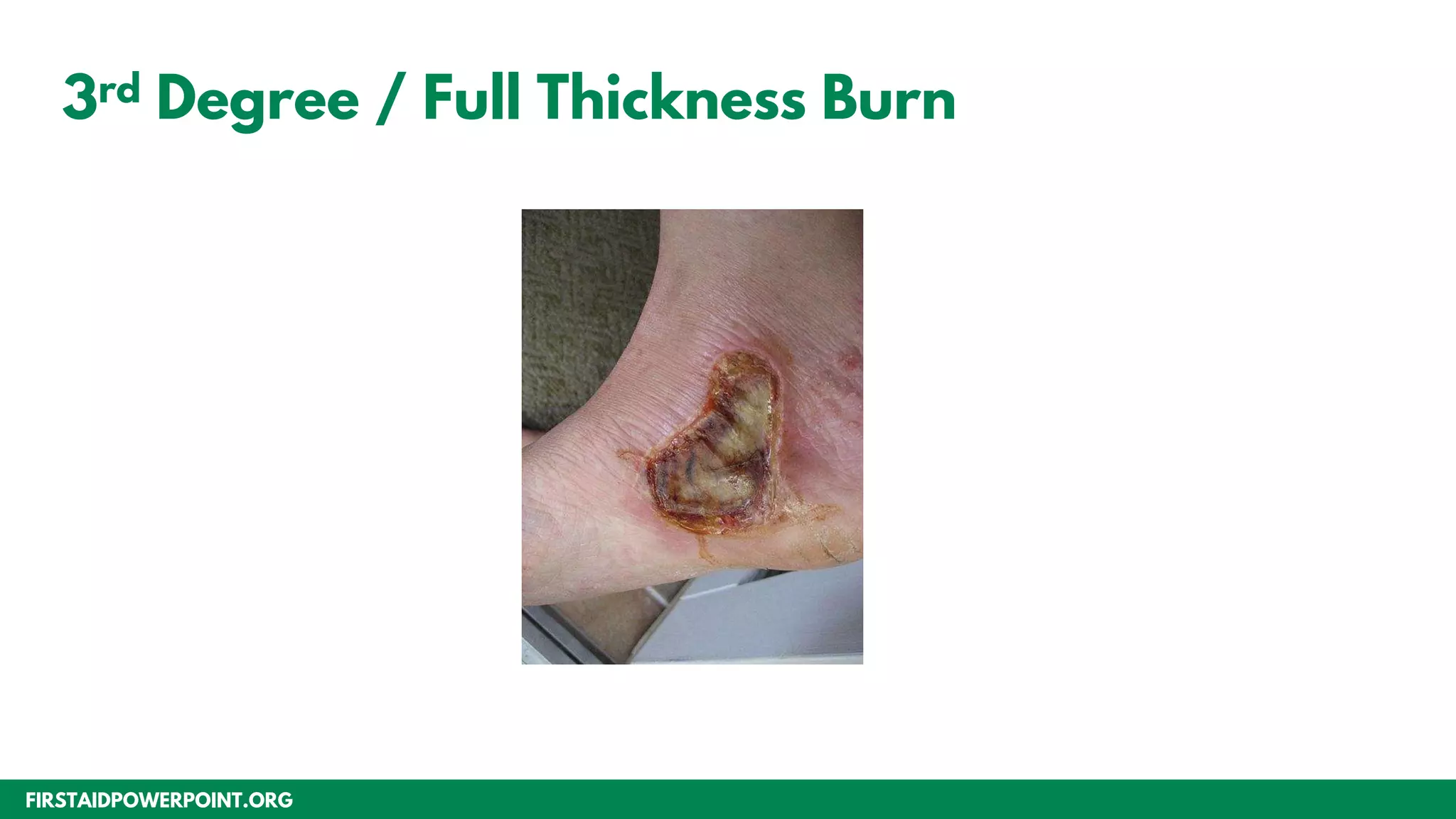 Trauma - Burn Injuries | PPTX