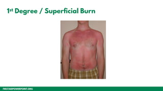 Trauma - Burn Injuries | PPTX