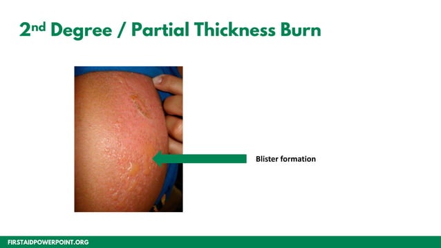 Trauma - Burn Injuries | PPT