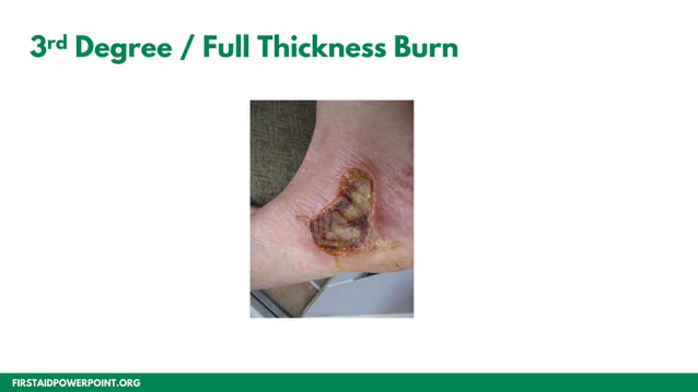 Trauma - Burn Injuries | PPT