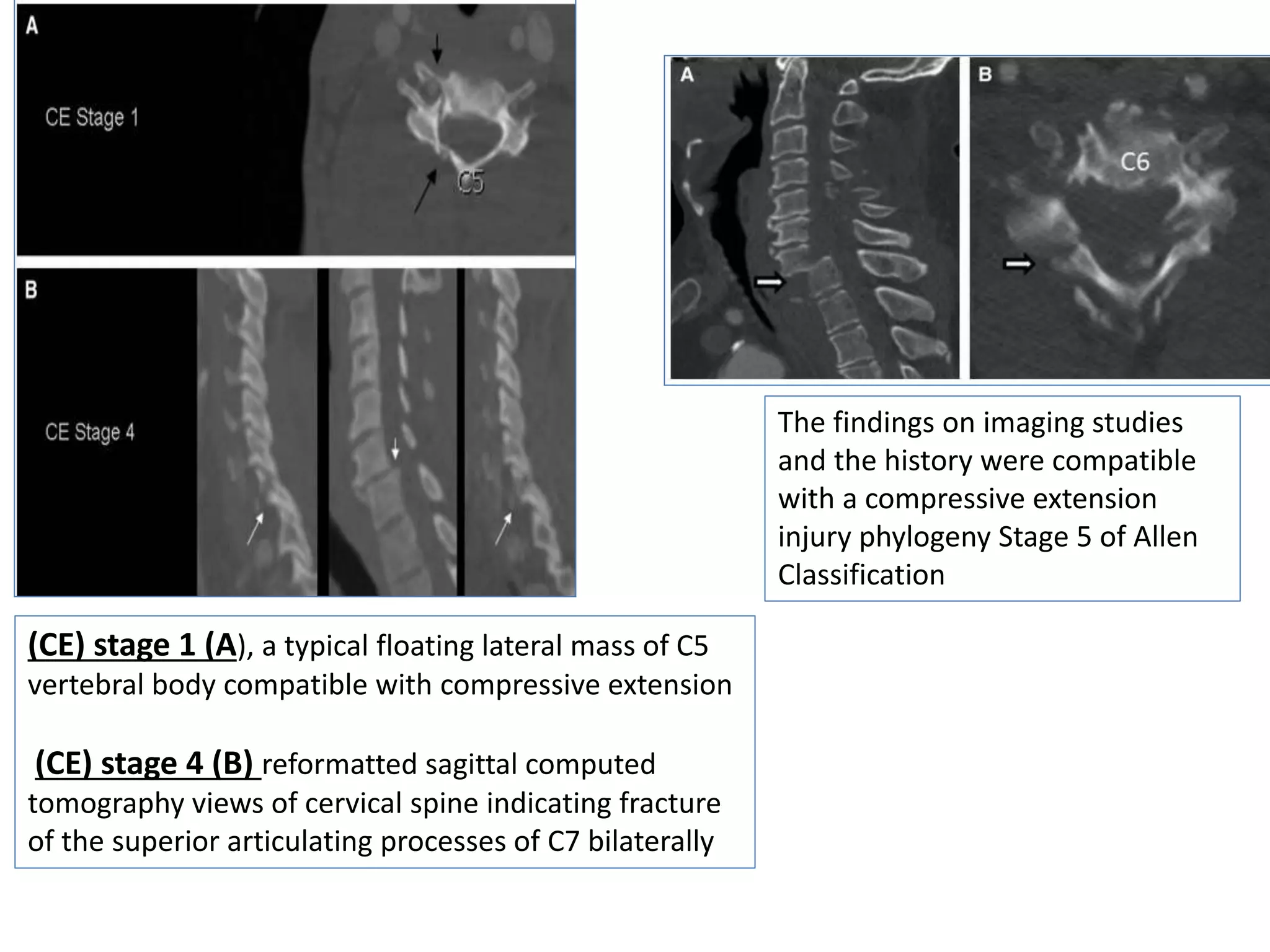 cervical Trauma classification | PPTX