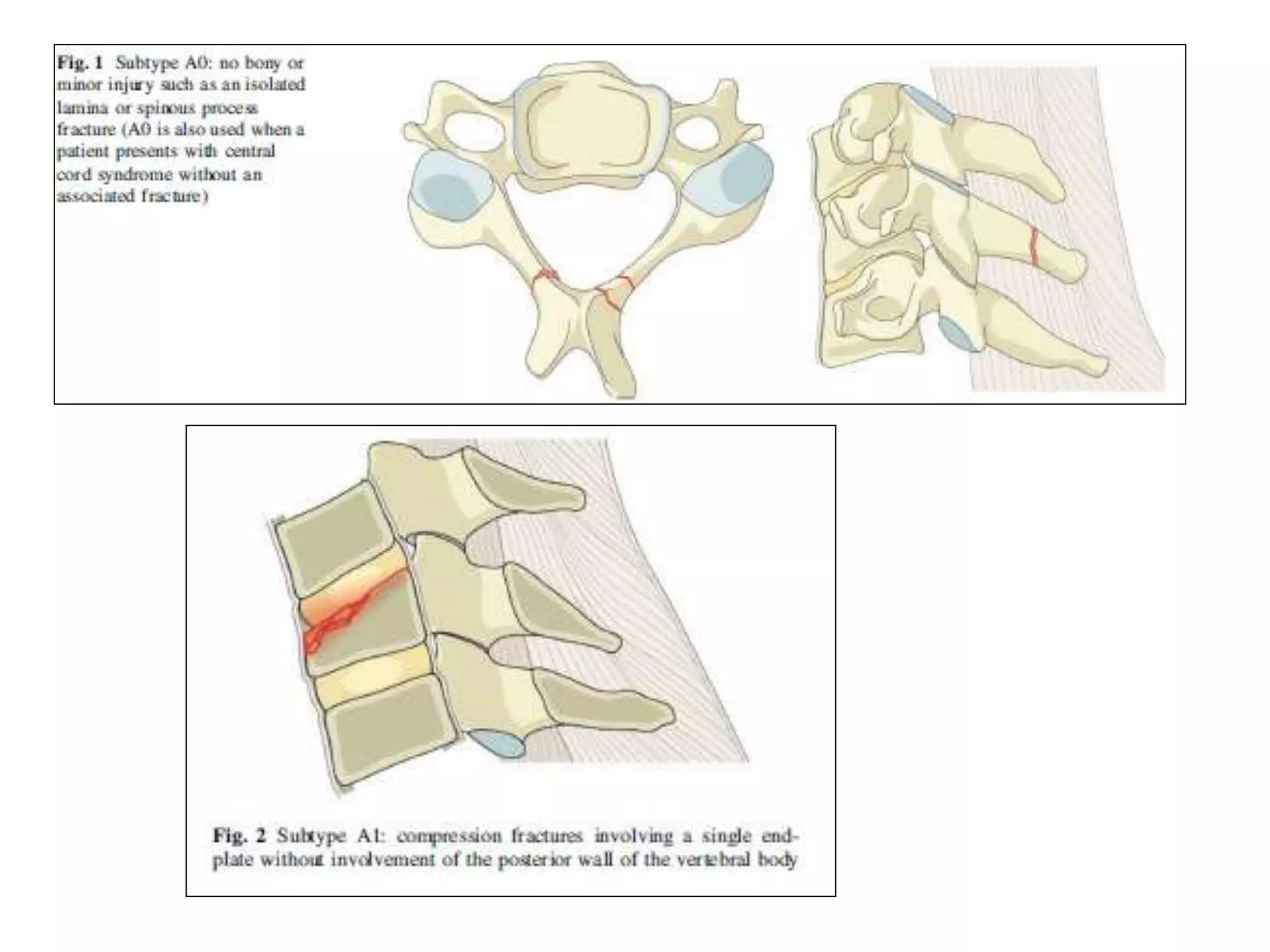 cervical Trauma classification | PPTX