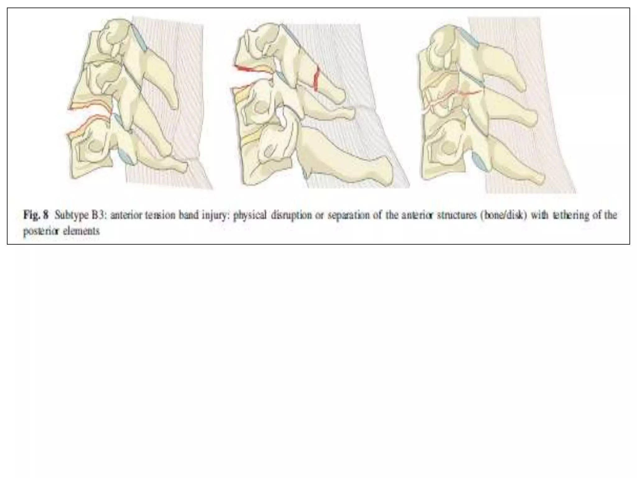 cervical Trauma classification | PPTX