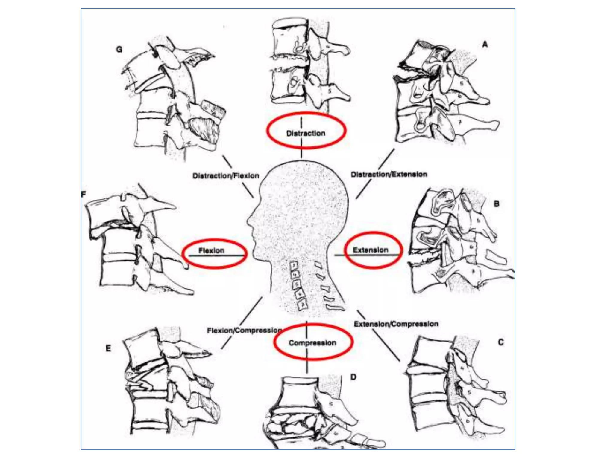 cervical Trauma classification | PPTX