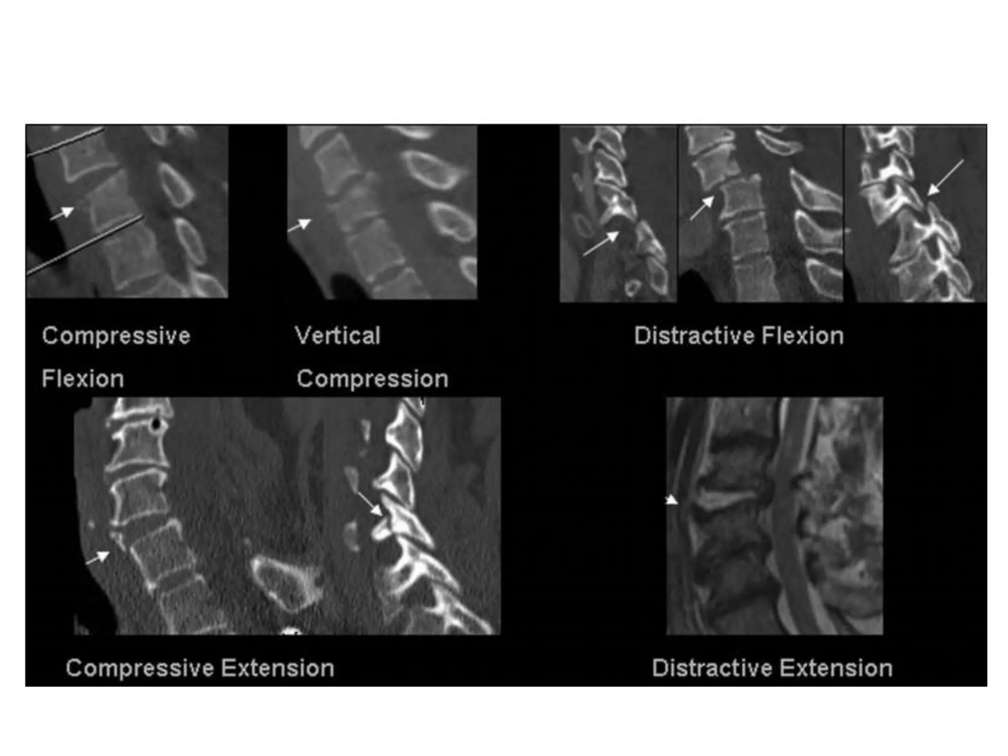 cervical Trauma classification | PPTX