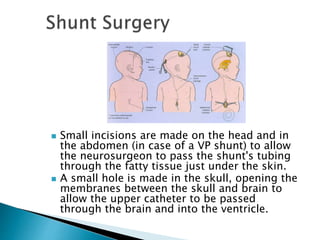 TRAUMA-HYDROCHEPALUS-LAMINECTOMY.ppt