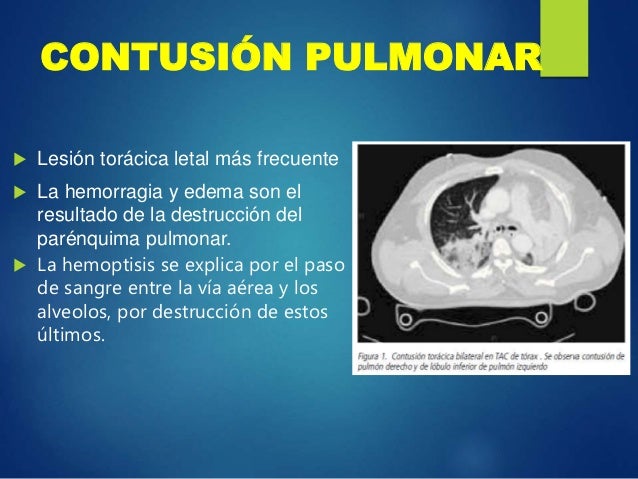 Contusion Pulmonar