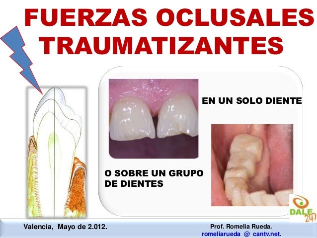 Trauma Oclusal Periodoncia