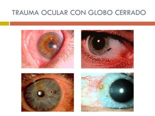 Trauma%20 ocular | PDF