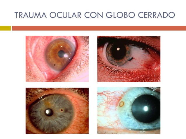 Trauma%20 ocular | PDF | Death, Injury, or Military Conflict ...