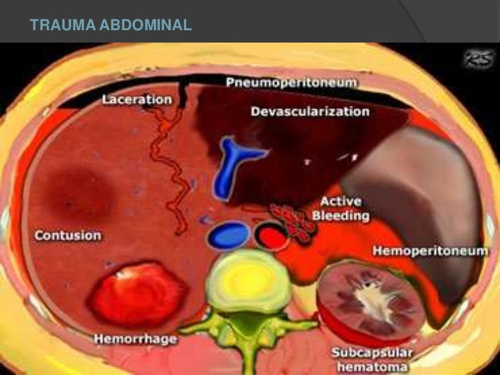 Trauma Abdominal